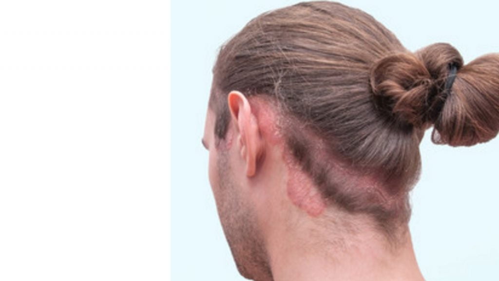 Seboreja | Dermatologijos klinika Vilniuje